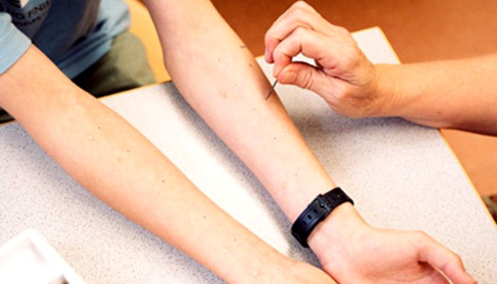 Alergiile: simptome, cauze, tratament și prevenție